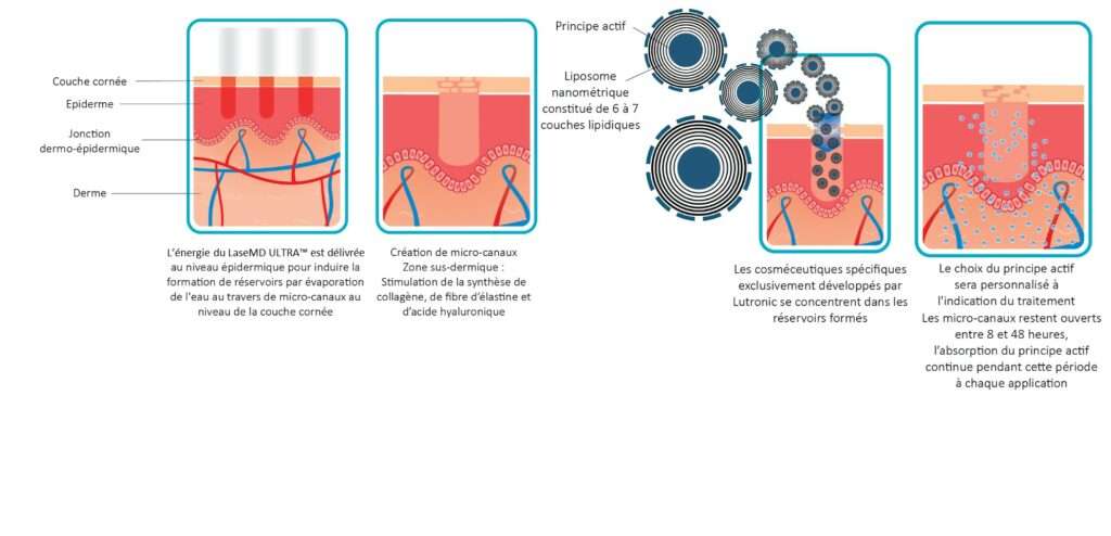 LaseMd Ultra™ - Lutronic powered by Seriderm