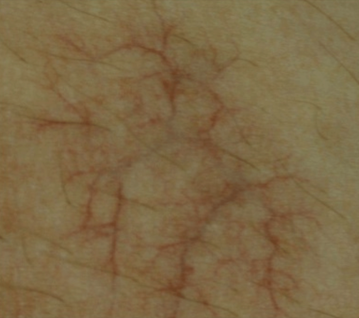 Clarity II™ - Lutronic powered by Seriderm